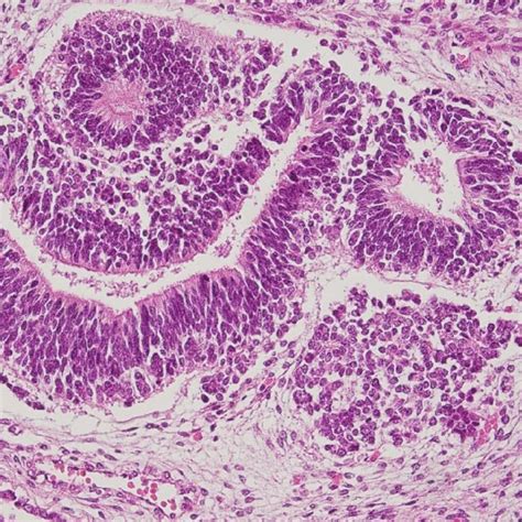 Immature Elements Of The Tumor Neuroectodermal Structures With