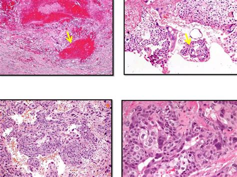 Germ Cell Tumors Of Ovary Pptx
