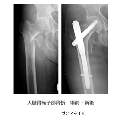 大腿骨頸部・転子部骨折について 豪徳寺整形外科クリニック 世田谷区 経堂 梅ヶ丘 宮の坂 山下 スポーツ・リハビリ 東京