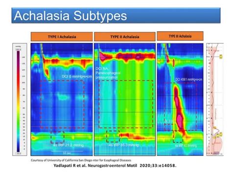 Chicago Classification Version 40 Hrm Classification Of Esophageal