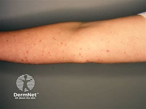 Infantile Papular Acrodermatitis Gianotti Crosti Images