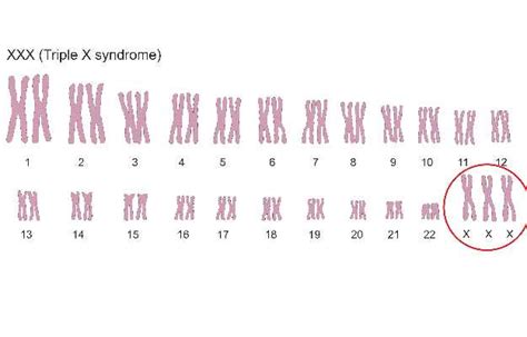 ट्राइसोमी एक्स के लक्षण कारण इलाज दवा उपचार डॉक्टर बचाव Trisomy