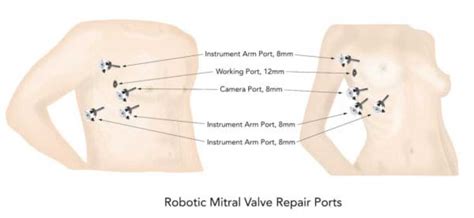 Endoscopic Robotic Mitral Valve Repair In New York City