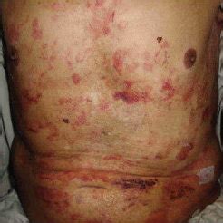 Hemorrhagic Blister With Ecchymoses And Erosions On The Trunk