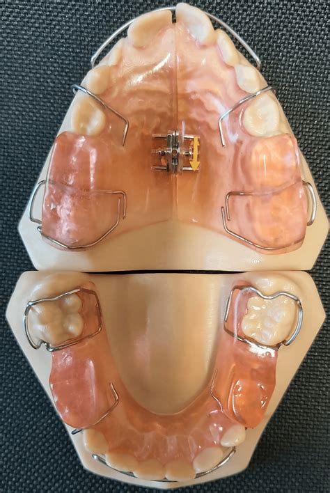 Twin Block Laboratoire Dentaire Orthodesign Sarl