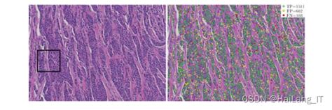 毕业设计 基于深度学习的数字病理图像分割 Csdn博客