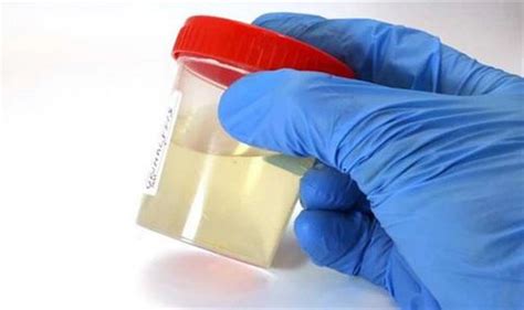 Nước Tiểu đục Là Bệnh Gì 11 Nguyên Nhân Và Dấu Hiệu Cảnh Báo