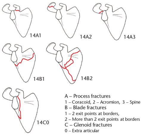 Scapula Fracture Ideberg Classification At Jorge Courter Blog Scapula Fracture Ideberg Classification At Jorge Courter Blog