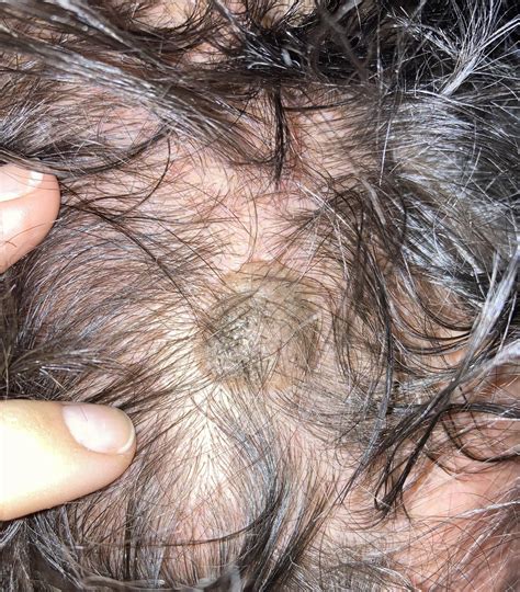 Lump On Scalp Should We Be Concerned R Dermatologyquestions