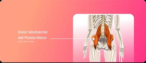 Dolor Miofascial Del Psoas Ilíaco