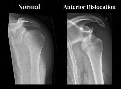 Anterior Shoulder Dislocation Msk Something About Radiology Just