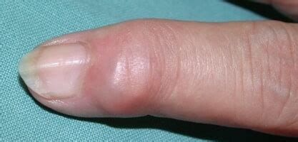Hand Ganglion Treatment And Removal Hand Surgery Associates