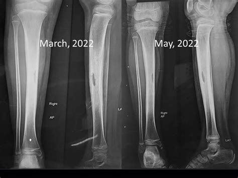 Chronic Recurrent Multifocal Osteomyelitis A Care Reportpptx