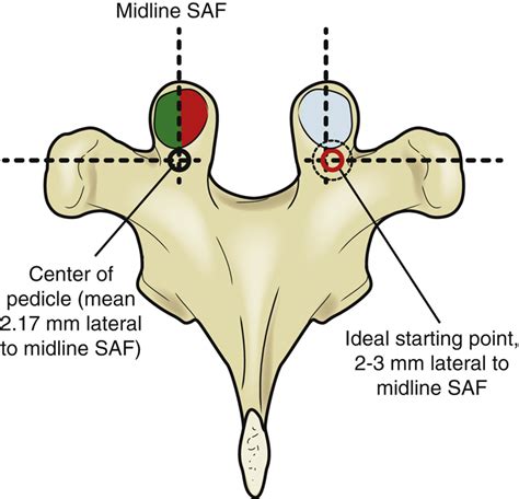Placement Of Thoracic Pedicle Screws Musculoskeletal Key