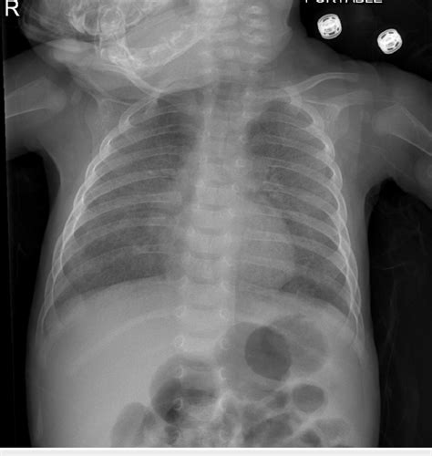 Chest X Ray Revealed Bilateral Opacities At Mid And Lower Lung Zones