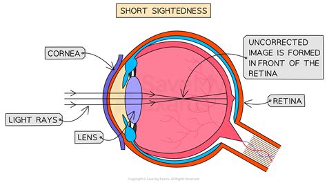 A Ray Diagram Showing How Light Rays Enter The Human Eye With Cataracts
