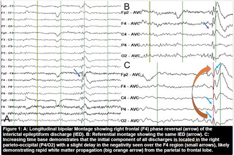 Understanding Epilepsy Networks And Rapid White Matter Propagation Of Epileptogenicity Through