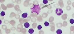 Chronic Lymphocytic Leukemia Cll Oncology Medbullets Step 23
