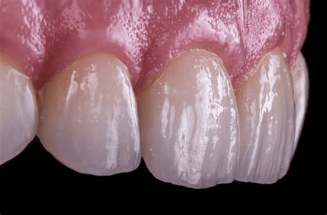 The Difference Between A Crown Veneer Center For Restorative Cosmetic Dentistry