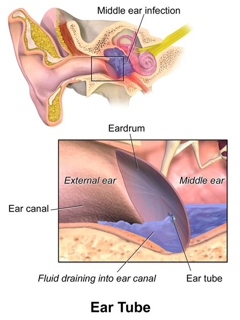 Tympanostomy Tube Placement Procedure