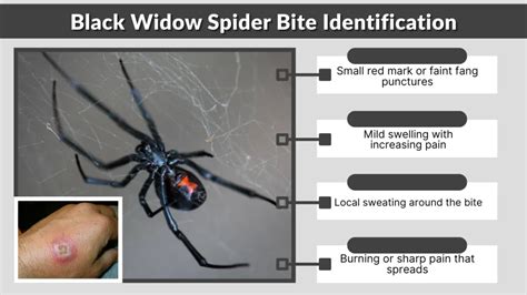 Black Widow Spider Bite Treatment Symptoms First Aid And Recovery