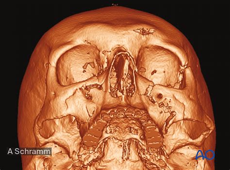 Cas Virtual Planning And Intraoperative Navigation Orif With Orbital Reconstruction