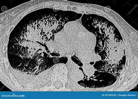 Cat Scan Of Bilateral Lung Infection And Right Pleural Effusion Stock