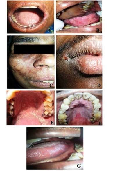A Angular Stomatitis In An Acquired Immunodeficiency Syndrome Aids Download Scientific