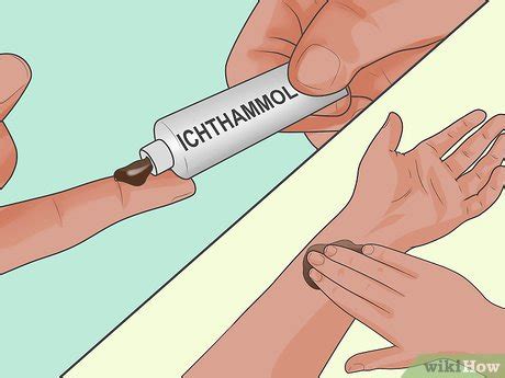 How To Painlessly Remove A Splinter 11 Steps With Pictures