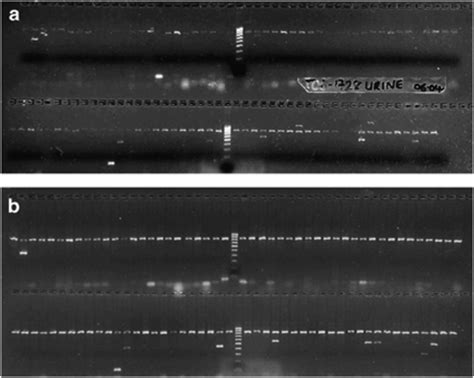 Representative Result Of PCR SSP For HLA Class I Typing Of Recipient Download Scientific