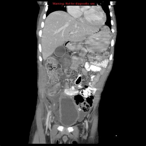 Appendicitis With Phlegmon Radiopaedia 9358 10046 B Nc Commons
