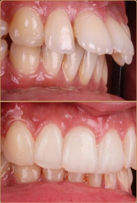 Invisalign Overbite Ruh Dental