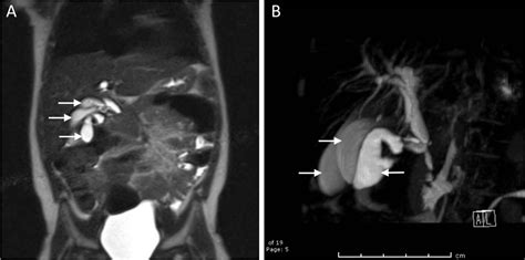 Gallbladder Duplication Pacs Gallbladder Duplication Pacs