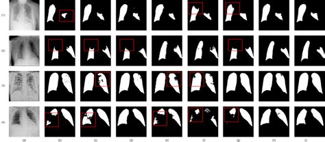 Visual Comparison Of Lung Infection Segmentation Results With Other Download Scientific Diagram