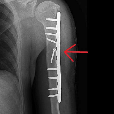 Anterior Posterior Radiograph Showing Orif With Plate Osteosynthesis Download Scientific