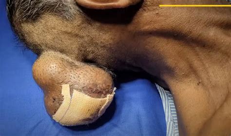 Relief After Ages Large Sebaceous Cyst Excision On Scalp New Pimple