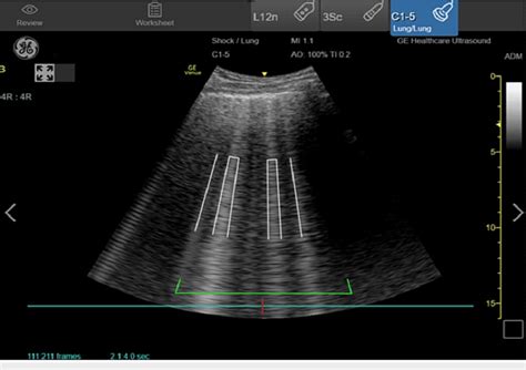 Point Of Care Ultrasound With Semi Automated Software Platform With B Lines Download