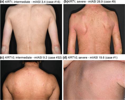 Epidermolytic Ichthyosis Symptoms Successful Topical Adapalene