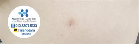 부산피지낭종 등 부위에 생긴 피지낭종 네이버 블로그