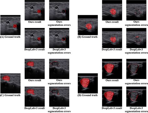 Frontiers N Net A Novel Dense Fully Convolutional Neural Network For Thyroid Nodule Segmentation