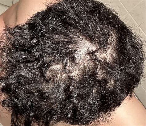 Hair Loss Telogen Effluvium R Malegrooming