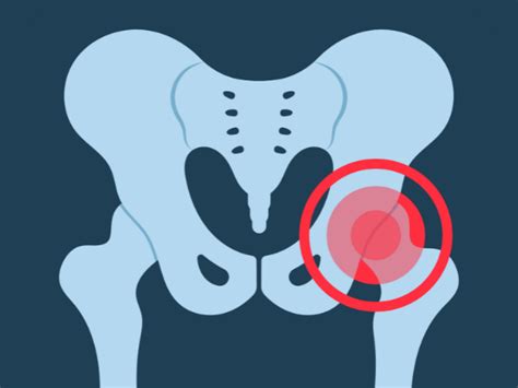 Benefits Of Surgery For Hip Fractures In Older Adults By