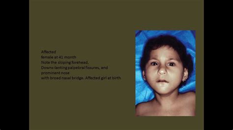 Duplication 15q Syndrome Youtube