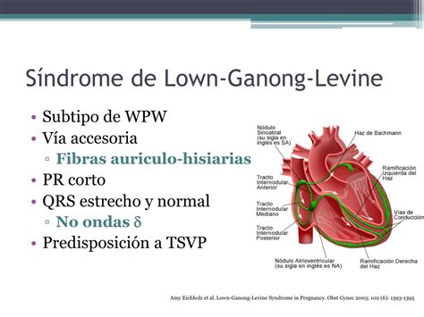 Ppt Extrasistolia Ventricular Síndromes De Preexitacion Wolff Parkinson White Lown Ganong