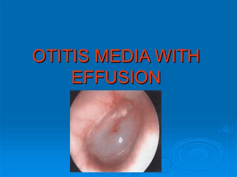 Ear Drainage Indicates Otitis Media With Effusion At Herlinda Means Blog