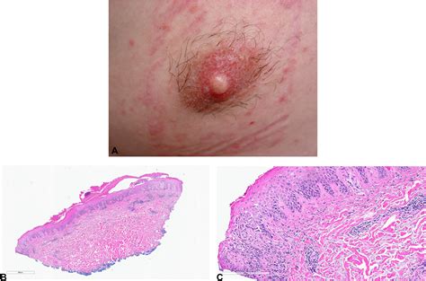 ‘eczematous Dermatitis Of The Nipple Clinical And Histopathological