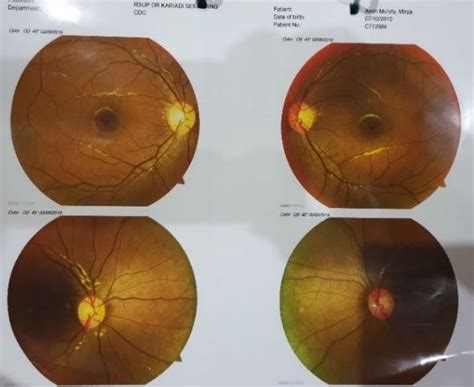 Fundus Colour Examinations Showed Normal Results Download Scientific