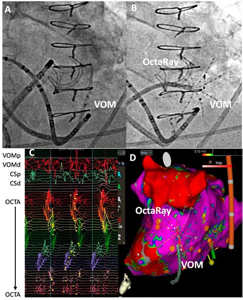 Po 06 123 Acute Termination Of Atrial Fibrillation During Ablation Using Artificial Intelligence