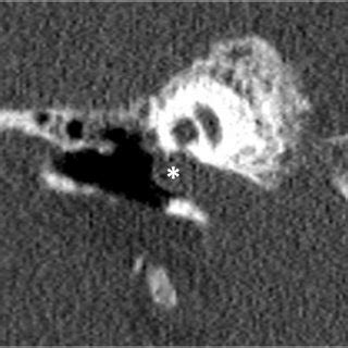 Right Temporal Bone Ct Scan In Axial A Coronal B And After IV Download Scientific Diagram