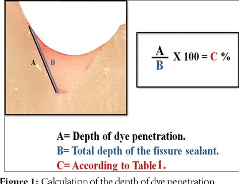 Figure From Microleakage Of A Pit And Fissure Sealant Used With Two Brands Of Self Etching